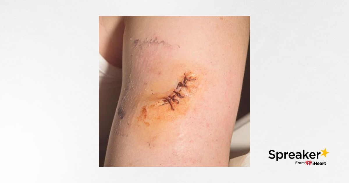 Sutures vs Stitches - Difference Between a Suture & a Stitch
