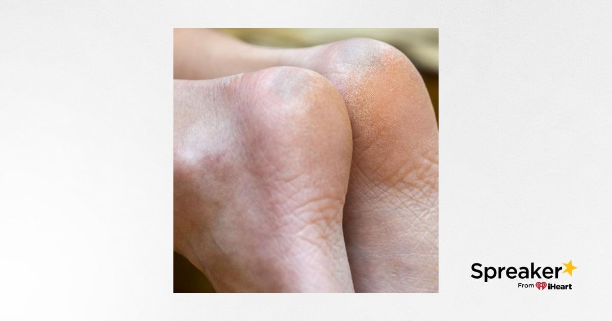 How to Remove Calluses From Feet and Get Rid of Them Permanently