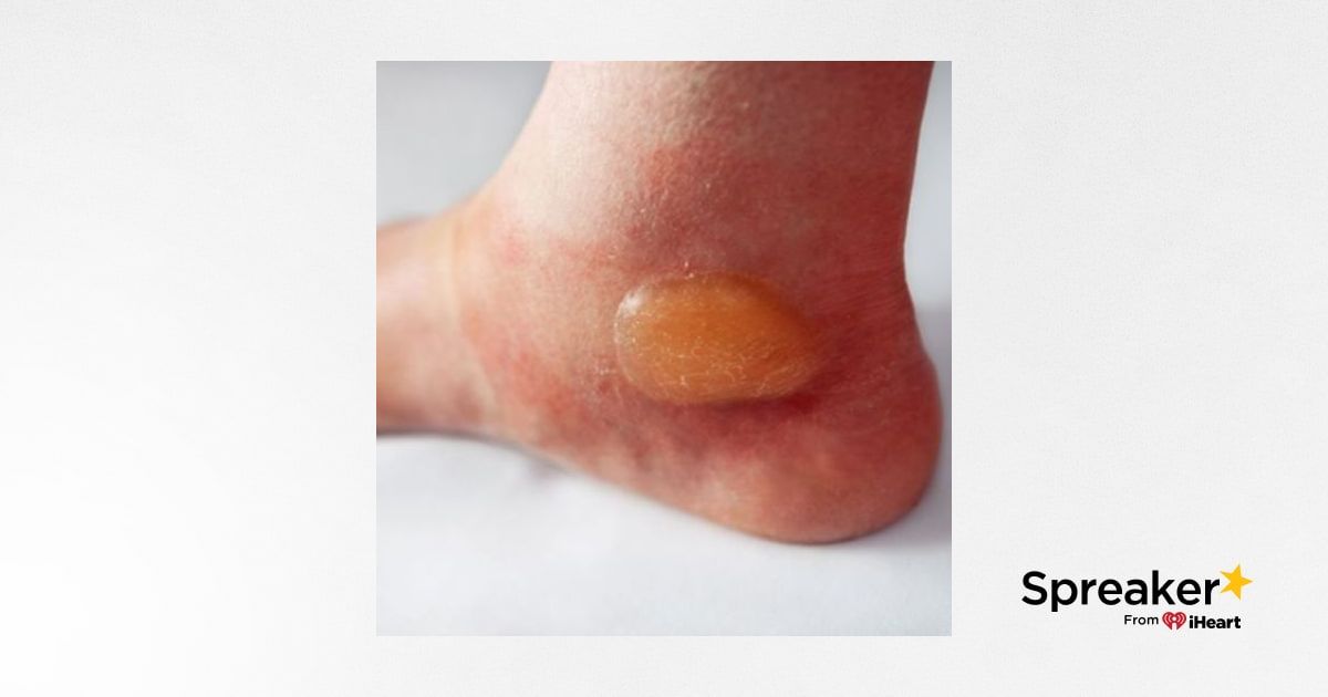 What Are Unexplained Blisters on Feet? Types of Foot Blisters Explained