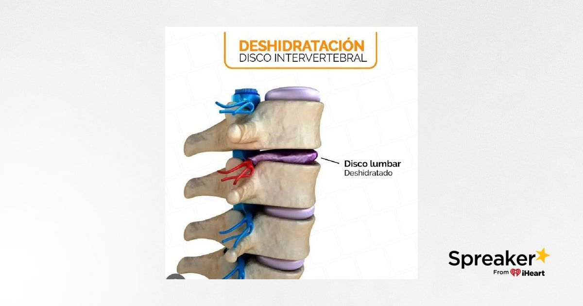 Que son los DISCOS DESHIDRATADOS DE LA COLUMNA