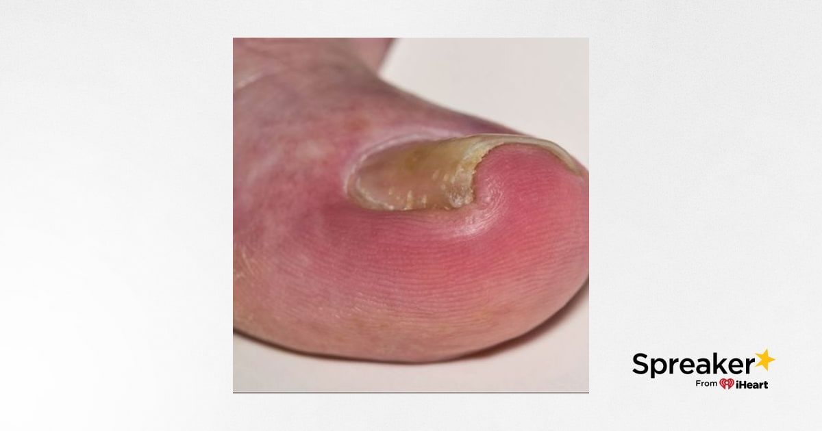 Swollen Infected Toe? Discover the Signs and Causes of Bacterial and ...