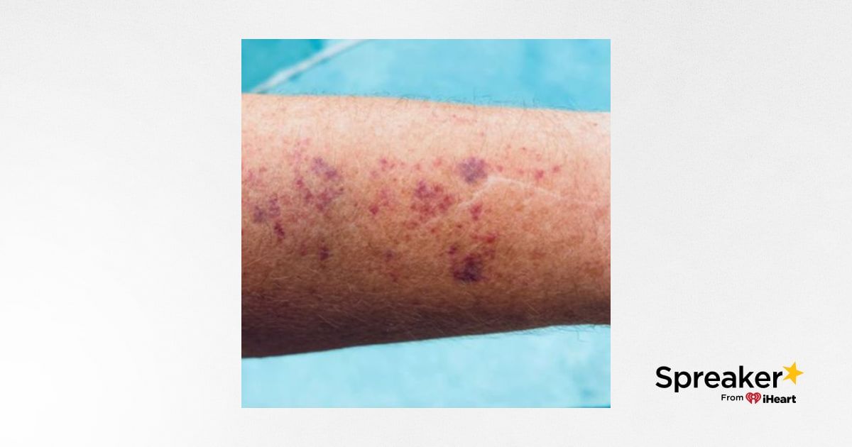 Petechiae vs. Purpura vs. Ecchymosis | Key Differences Explained ...