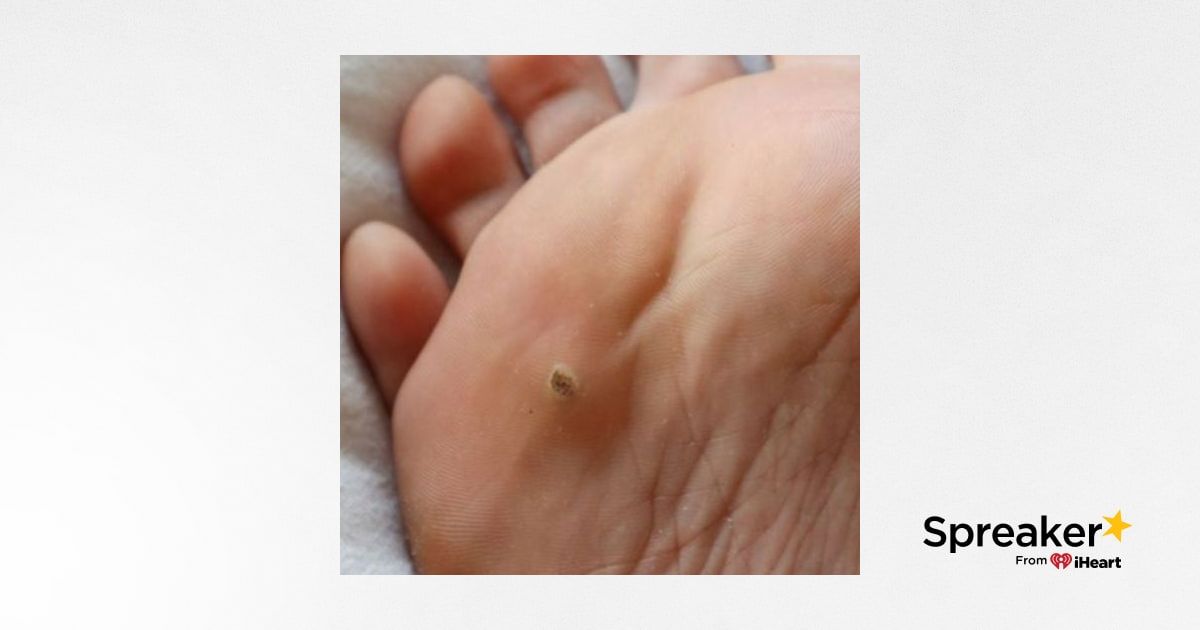 Corn Vs Wart - How to Tell the Difference Between Corns and Plantar ...