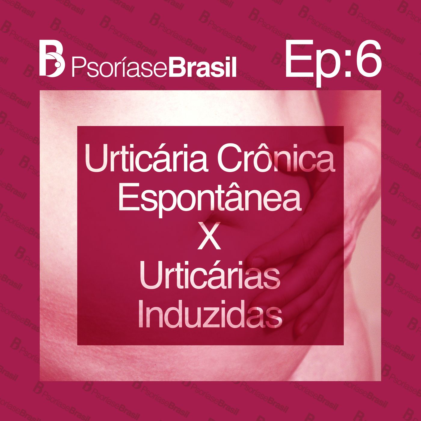 Urticária Crônica Espontânea X Urticárias Induzidas Doenças De Pele
