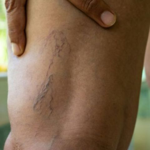 Do Blood Clots Look Like Bruises? | How to Tell the Difference – Learn ...